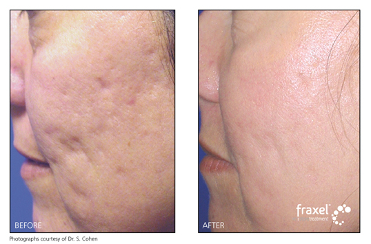 Acne Treatment Royal Tunbridge Wells Kent UK