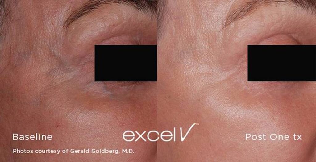 Excel V+ Laser for Veins and Pigmentation Royal Tunbridge Wells UK