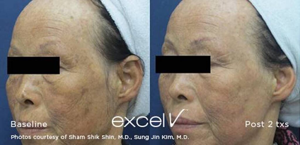 Excel V Laser for Veins and Pigmentation Royal Tunbridge Wells UK