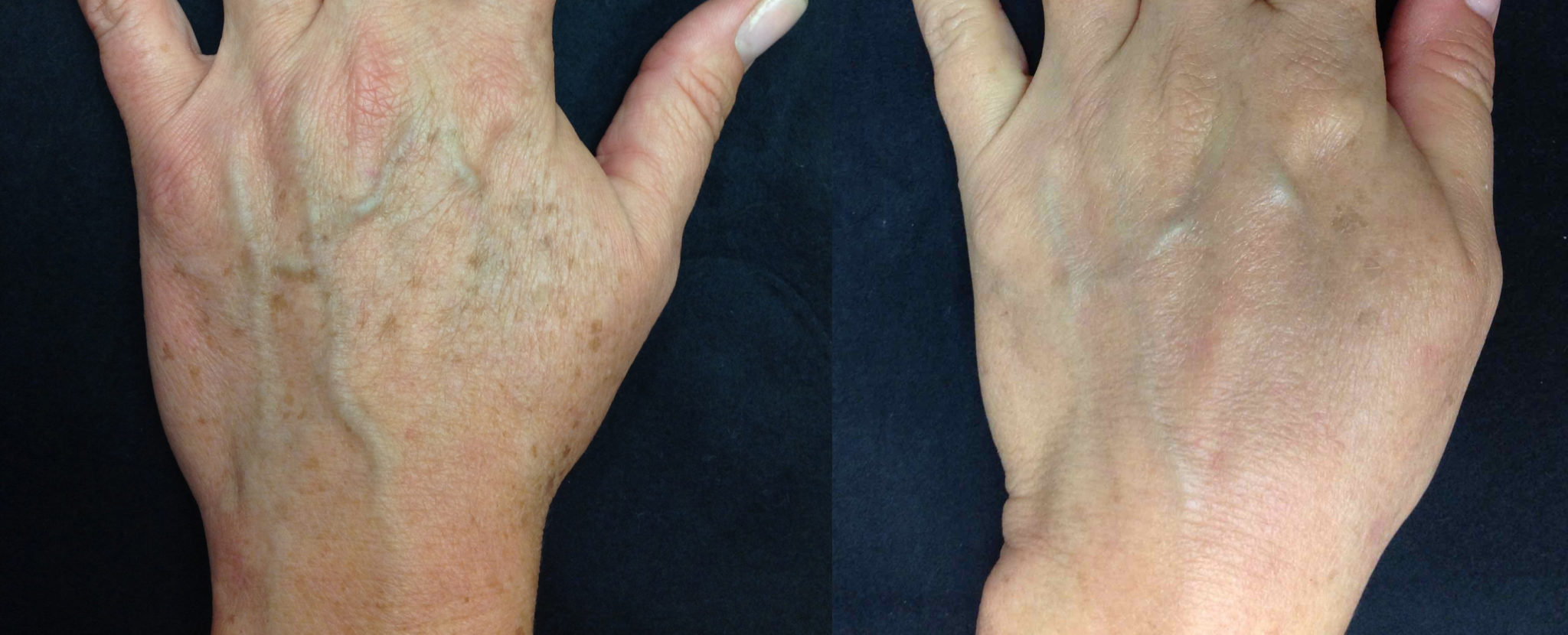 Hand Rejuvenation Radiesse Laser Resurfacing Royal Tunbridge Wells UK
