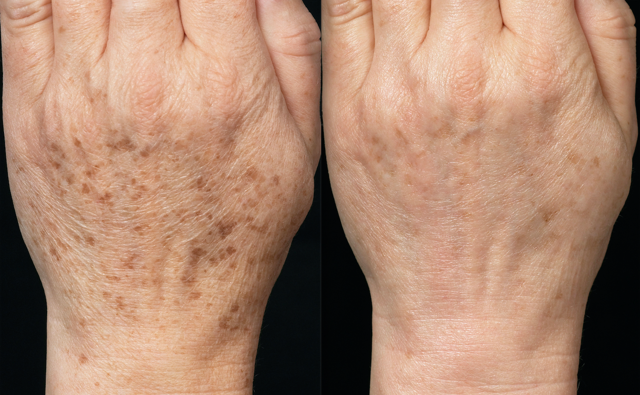 Hand Rejuvenation Radiesse Laser Resurfacing Royal Tunbridge Wells UK