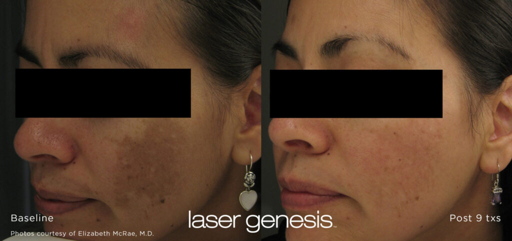 Excel V+ Laser for Veins and Pigmentation Royal Tunbridge Wells UK